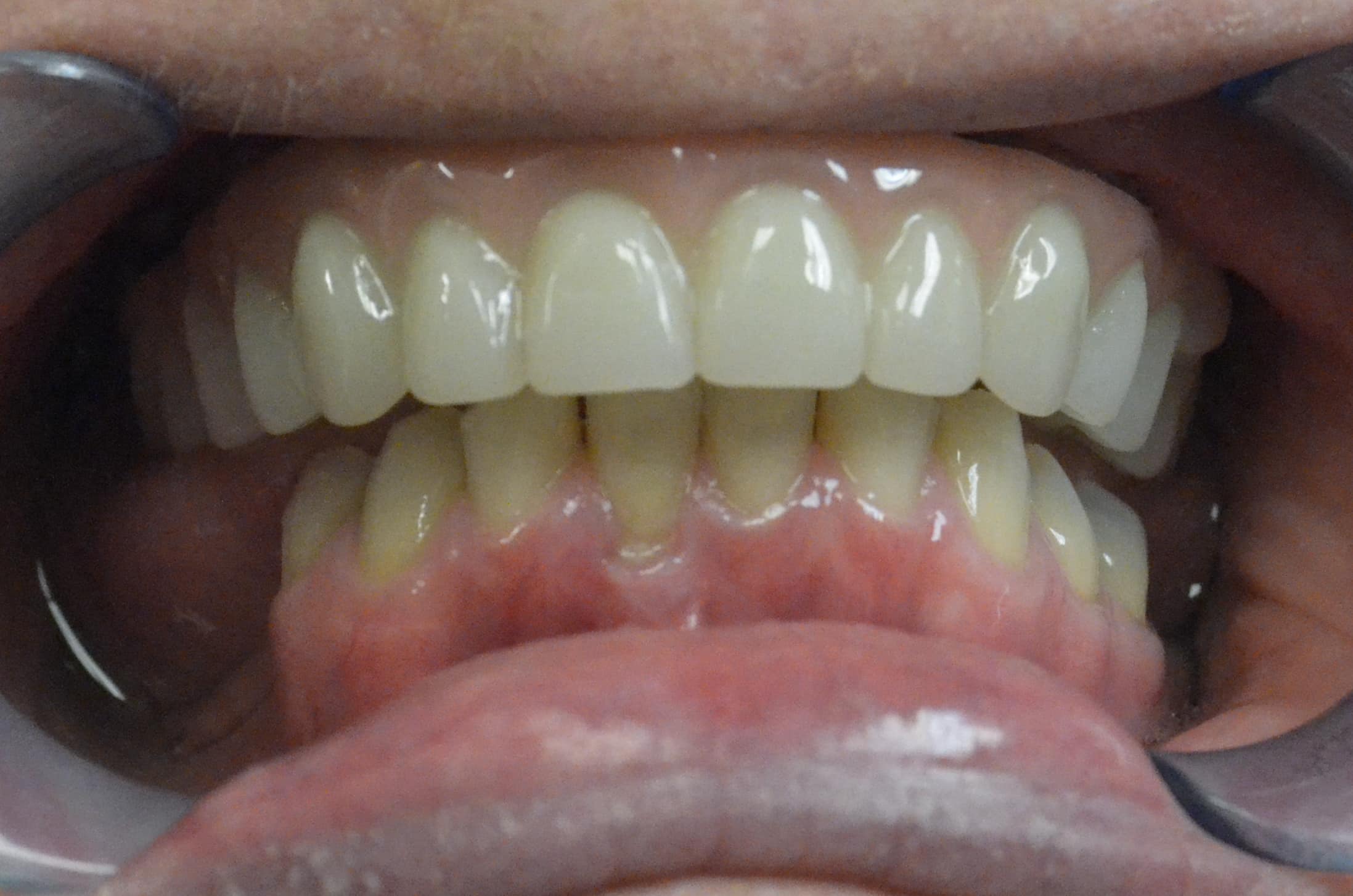 Before and After - DIAC